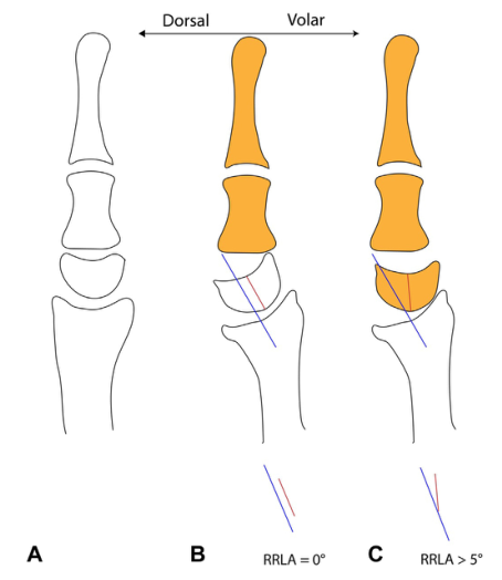 J Hand Surg Glob Online：腕关节错位伴桡骨远端畸形愈合及桡骨远端截骨术后矫治因素-MedSci.cn
