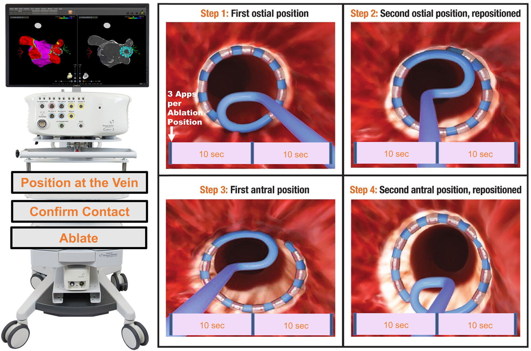 强生Varipulse风波，PFA消融市场趋势将何处去？-MedSci.cn