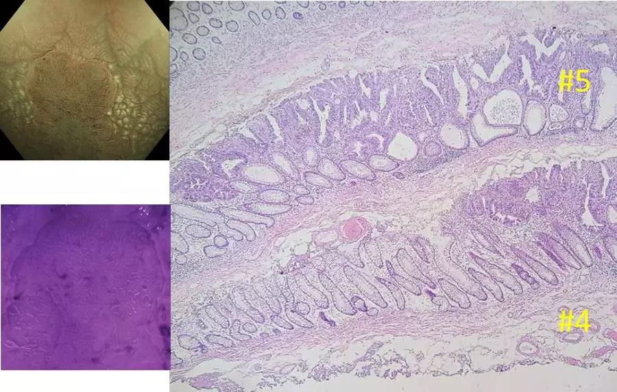 病例精讲：管中窥豹-JNET分型与工藤PP分型-MedSci.cn